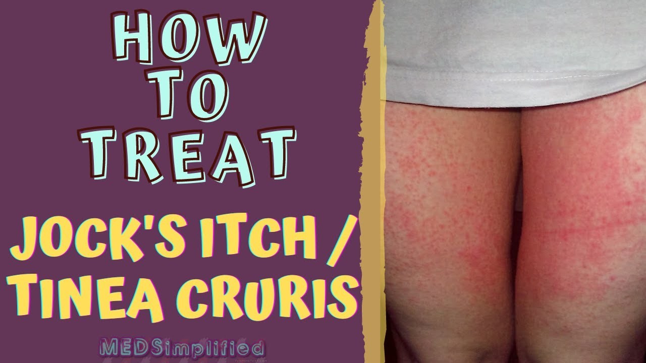 Beat Jock’s Itch: Here’s How to Keep It from Coming – Homesteading ...